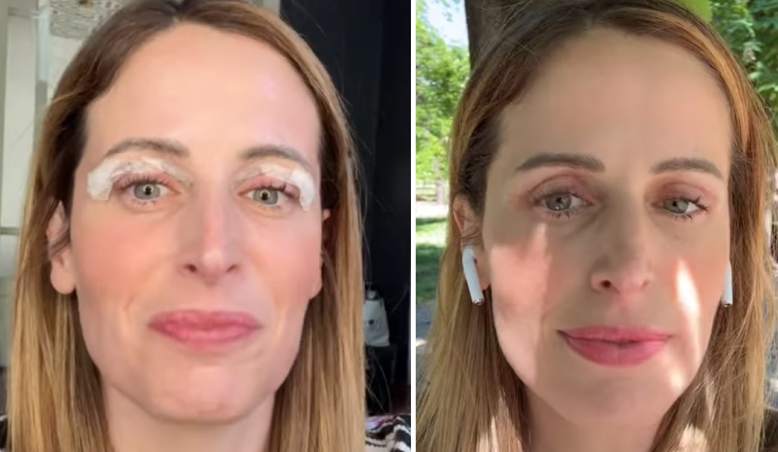 Clio MakeUp mostra gli occhi dopo aver rimosso i punti della ...